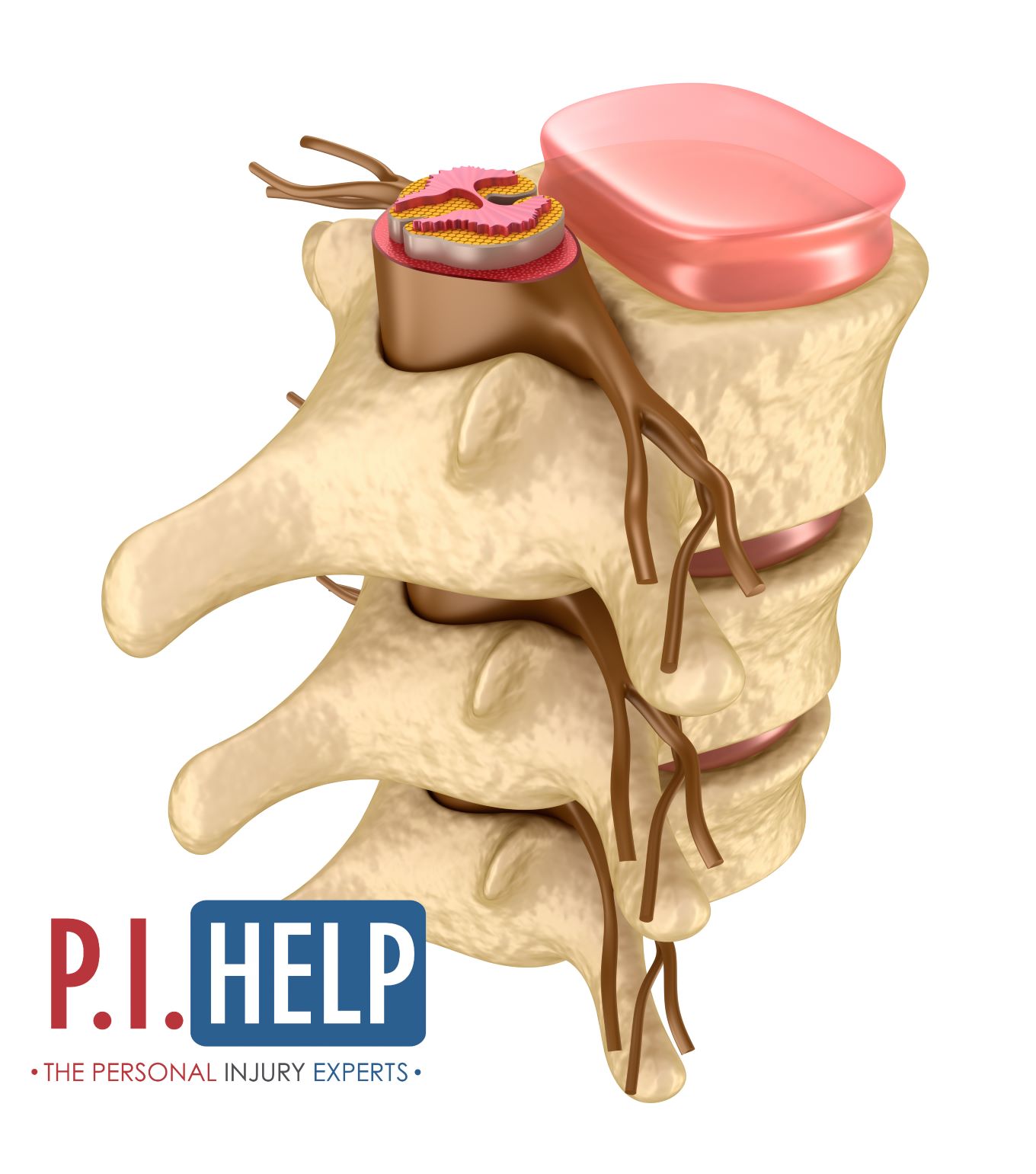 HERNIATED “SLIPPED” DISC AFTER A CAR ACCIDENT - P.I. HELP Injury ...